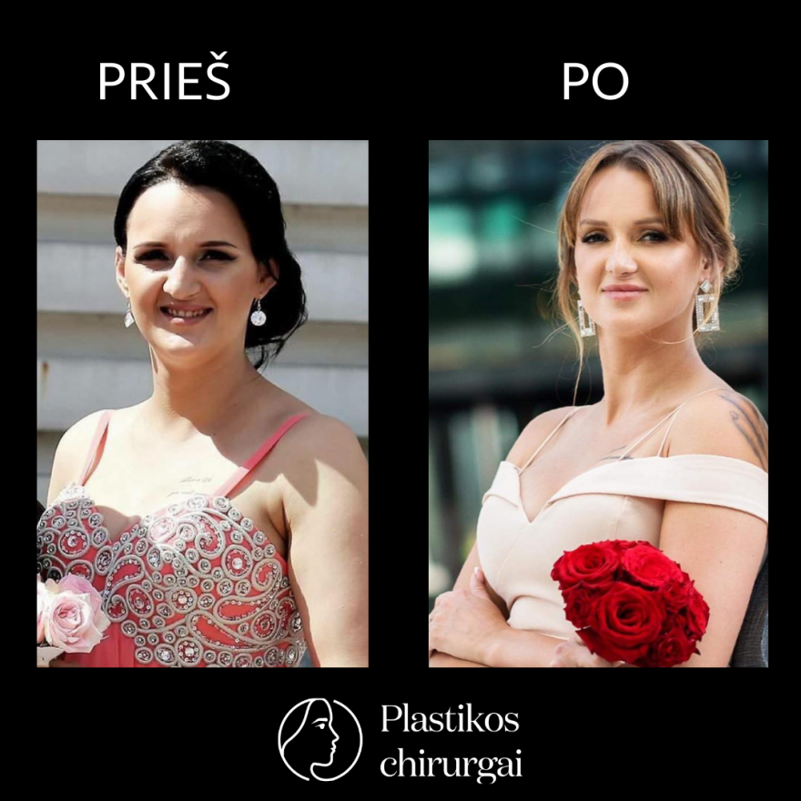 Veido ir kūno tobulinimas plastine chirurgija: svarbiausia patikti sau ...